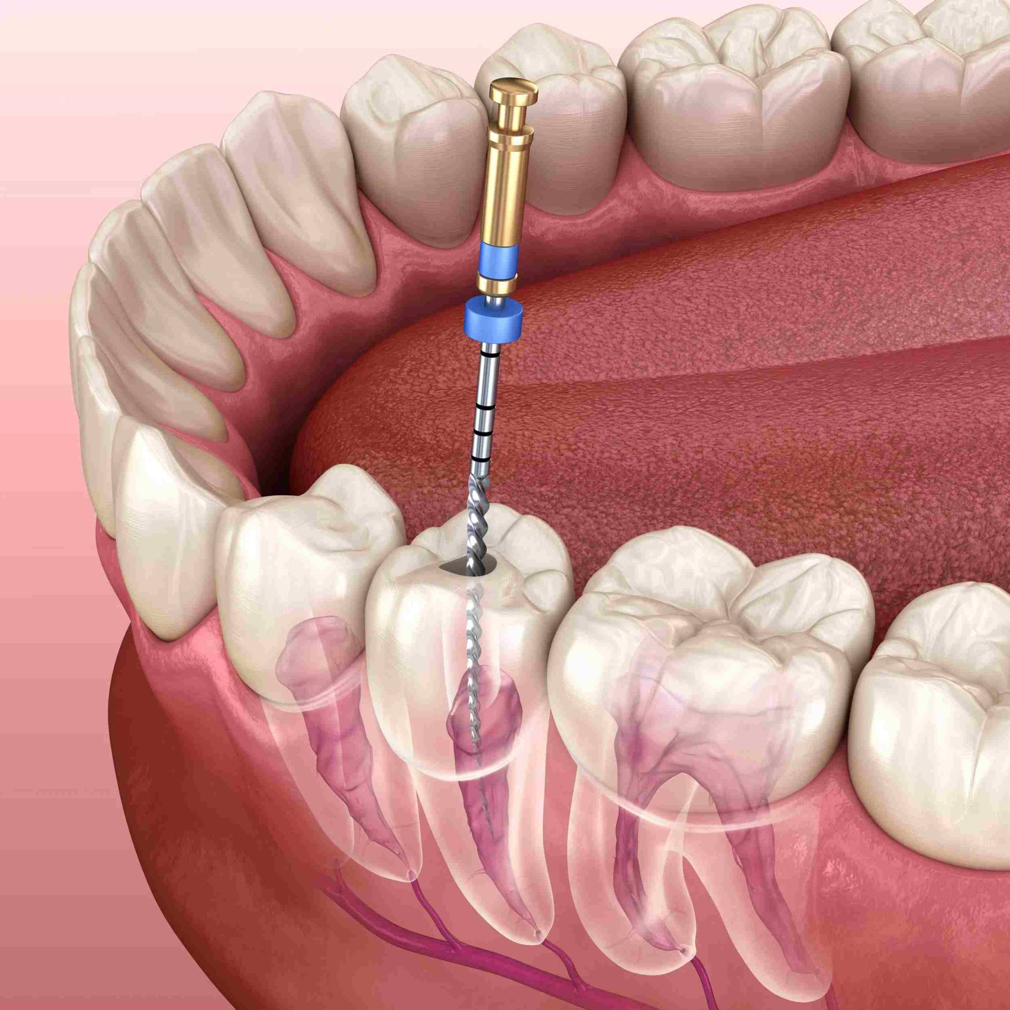 Root Canal Therapy - U Smile Family Dentistry